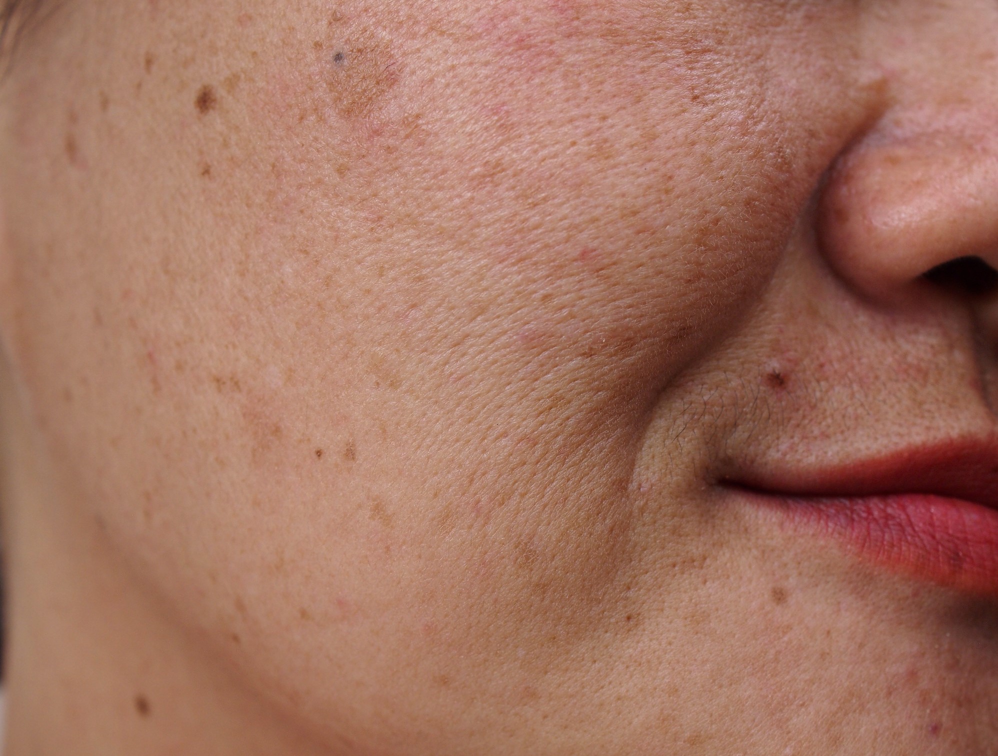 Laser Beauty Skin Center NY | Laser Skin Rejuvenation Services NY